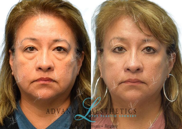 Blepharoplasty 21 - Advanced Aesthetics Lopez Plastic Surgery