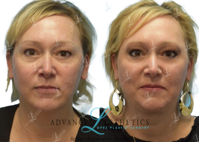 FaceTite 4 - Advanced Aesthetics Lopez Plastic Surgery