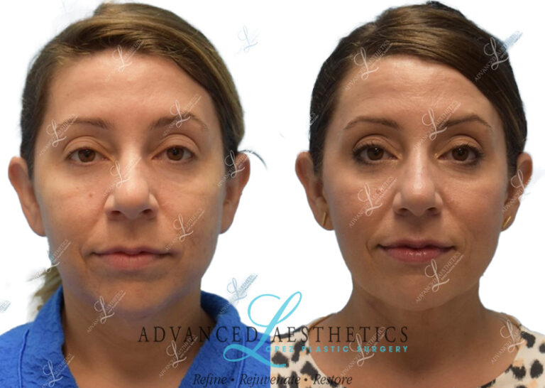 FaceTite 4 - Advanced Aesthetics Lopez Plastic Surgery