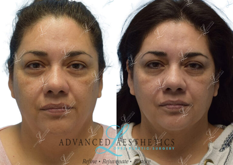 FaceTite 4 - Advanced Aesthetics Lopez Plastic Surgery