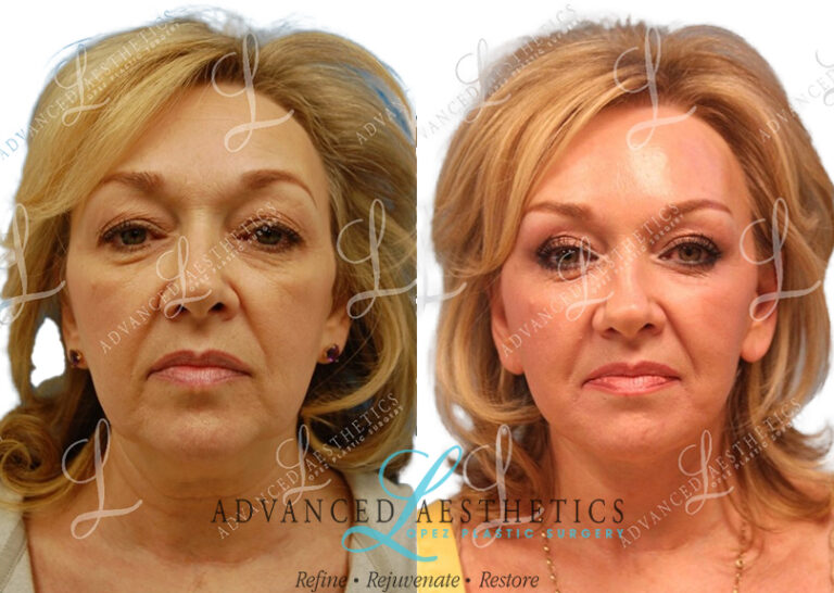 Facelift 34 - Advanced Aesthetics Lopez Plastic Surgery