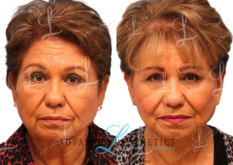 Facelift 38 - Advanced Aesthetics Lopez Plastic Surgery