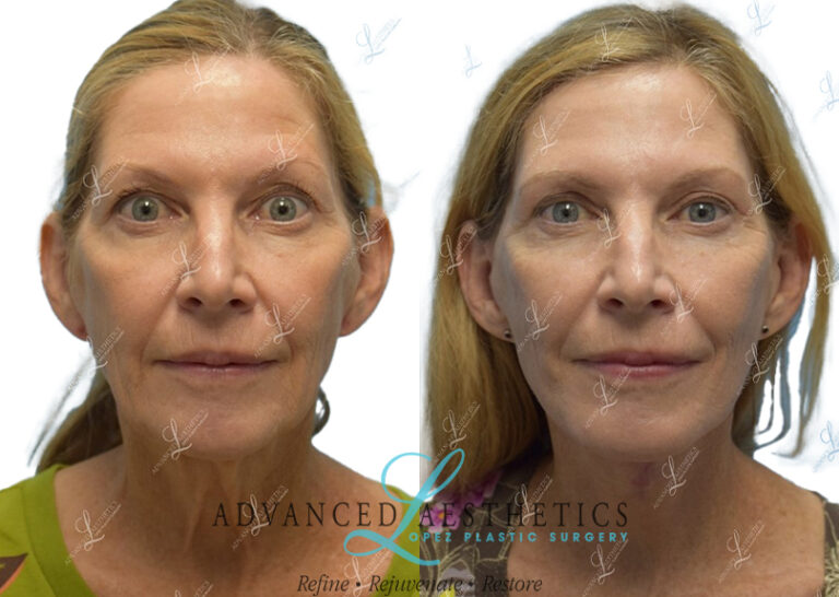 Facelift 38 - Advanced Aesthetics Lopez Plastic Surgery