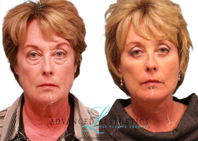 Facelift 38 - Advanced Aesthetics Lopez Plastic Surgery