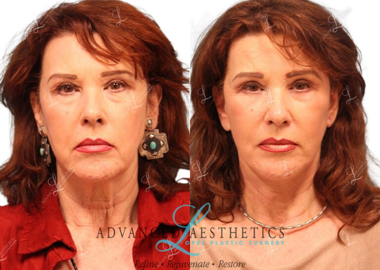 Facelift Before & Afters - Advanced Aesthetics Lopez Plastic Surgery