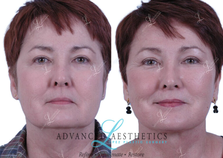Facelift 38 - Advanced Aesthetics Lopez Plastic Surgery