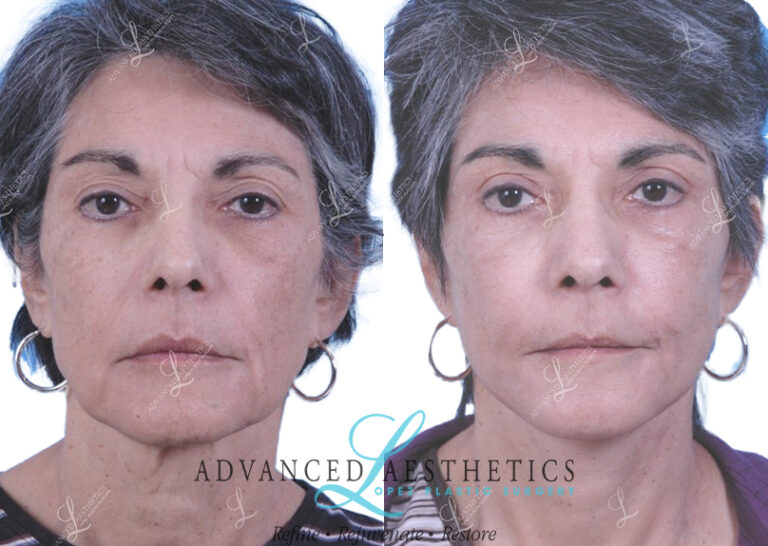Facelift 38 - Advanced Aesthetics Lopez Plastic Surgery