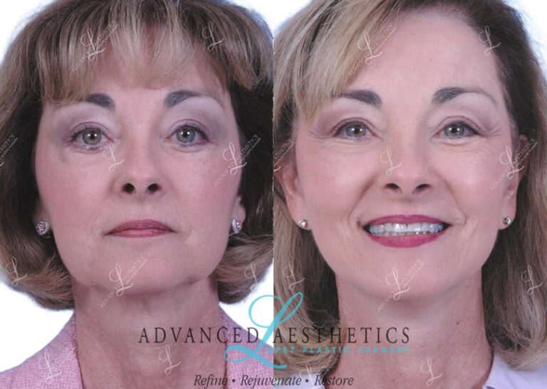 Facelift 38 - Advanced Aesthetics Lopez Plastic Surgery