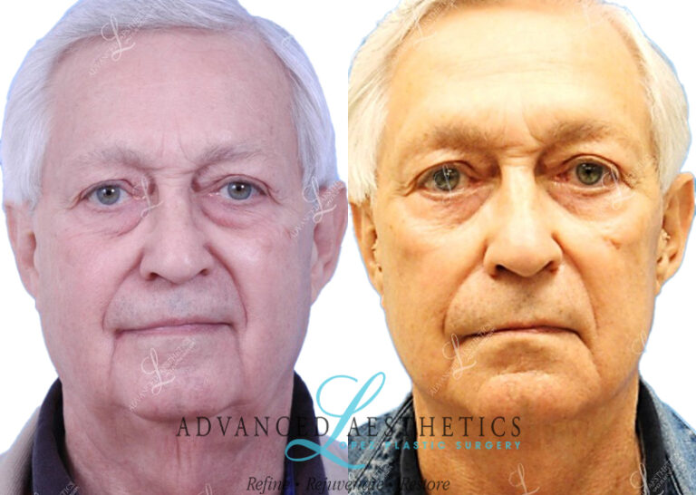 Facelift 38 - Advanced Aesthetics Lopez Plastic Surgery