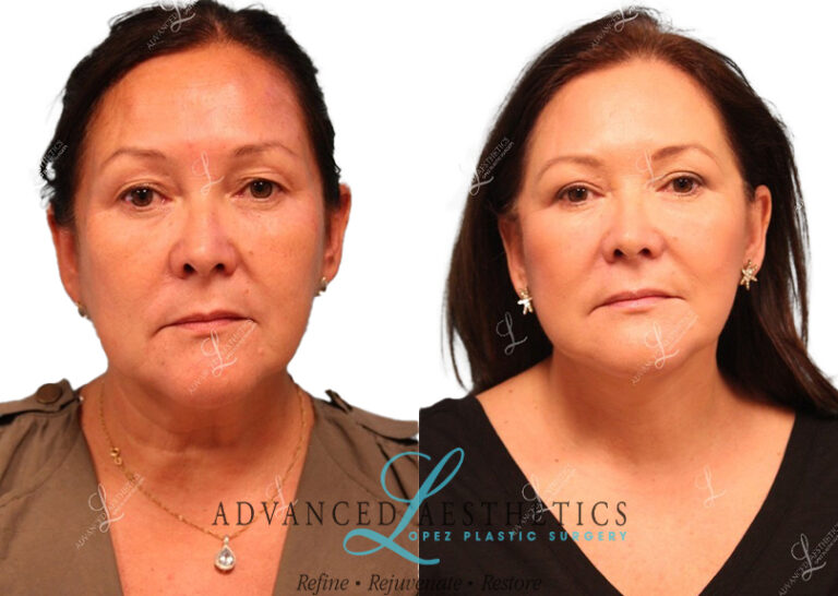 Facelift Before & Afters - Advanced Aesthetics Lopez Plastic Surgery