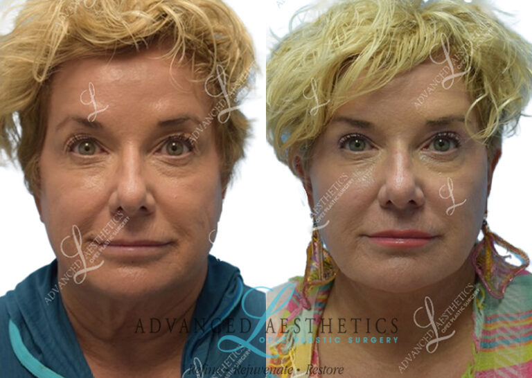Facelift 38 - Advanced Aesthetics Lopez Plastic Surgery
