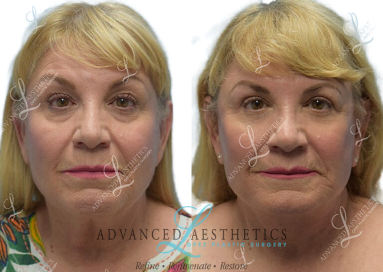 Facelift Before & Afters - Advanced Aesthetics Lopez Plastic Surgery