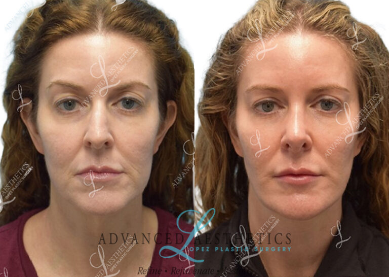 Facelift 38 - Advanced Aesthetics Lopez Plastic Surgery