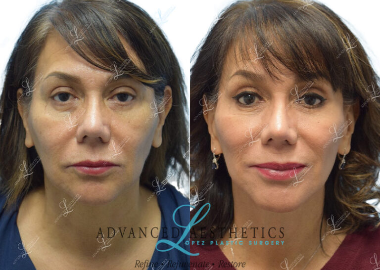 Facelift 38 - Advanced Aesthetics Lopez Plastic Surgery