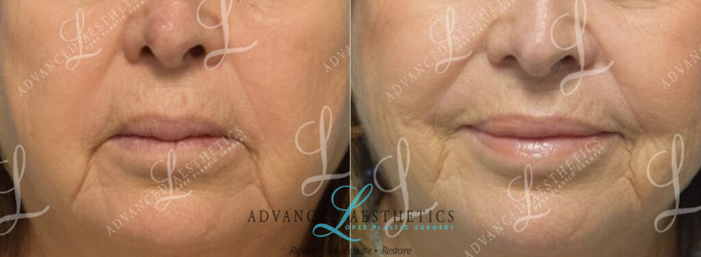 Lip Lift 2 - Advanced Aesthetics Lopez Plastic Surgery