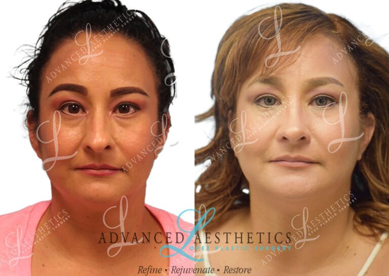Rhinoplasty 20 - Advanced Aesthetics Lopez Plastic Surgery