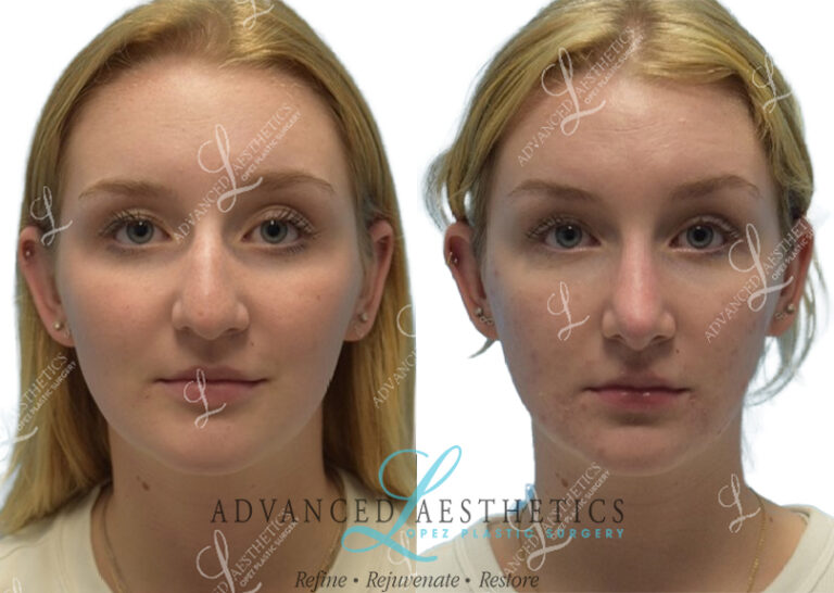 Rhinoplasty 9 - Advanced Aesthetics Lopez Plastic Surgery
