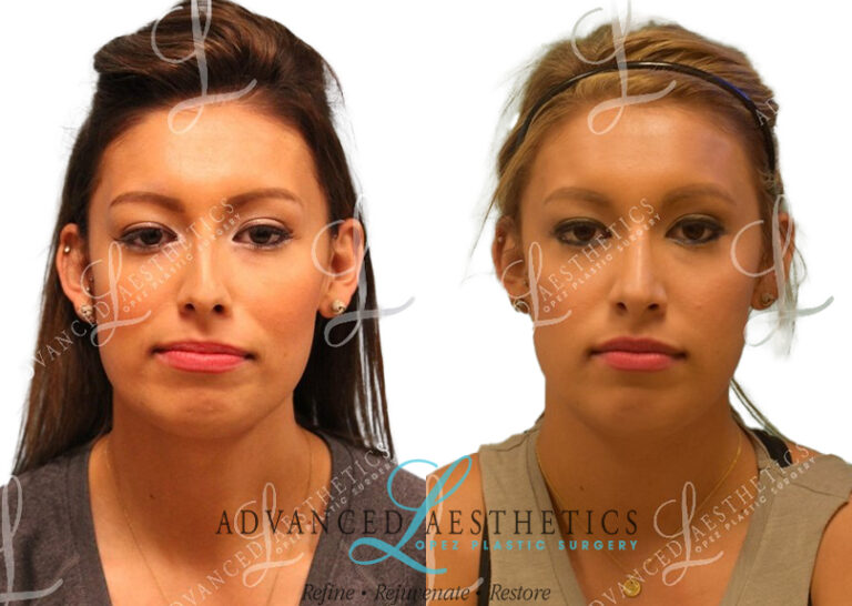 Rhinoplasty 20 - Advanced Aesthetics Lopez Plastic Surgery