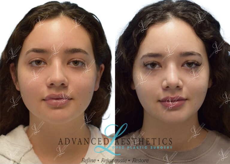 Rhinoplasty 2 - Advanced Aesthetics Lopez Plastic Surgery