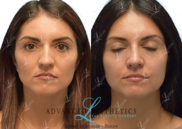 Rhinoplasty 20 - Advanced Aesthetics Lopez Plastic Surgery