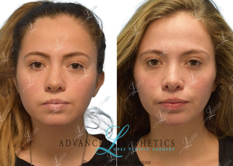 Rhinoplasty 9 - Advanced Aesthetics Lopez Plastic Surgery