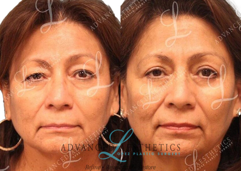 Blepharoplasty 2 - Advanced Aesthetics Lopez Plastic Surgery