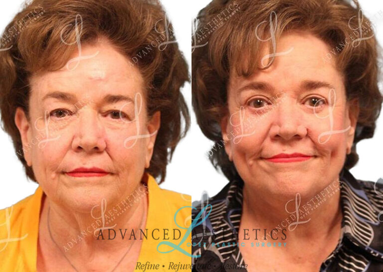 Facelift 38 - Advanced Aesthetics Lopez Plastic Surgery