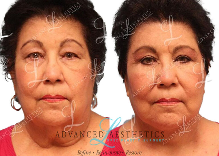 Facelift 38 - Advanced Aesthetics Lopez Plastic Surgery