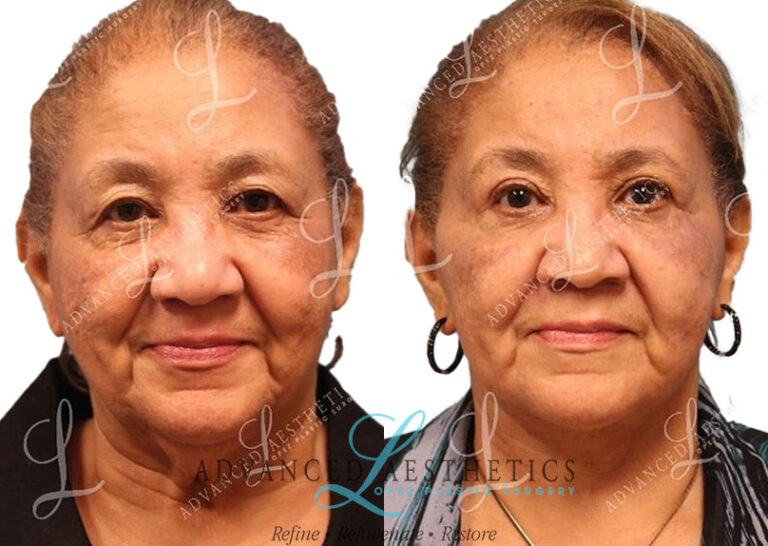 Facelift 38 - Advanced Aesthetics Lopez Plastic Surgery