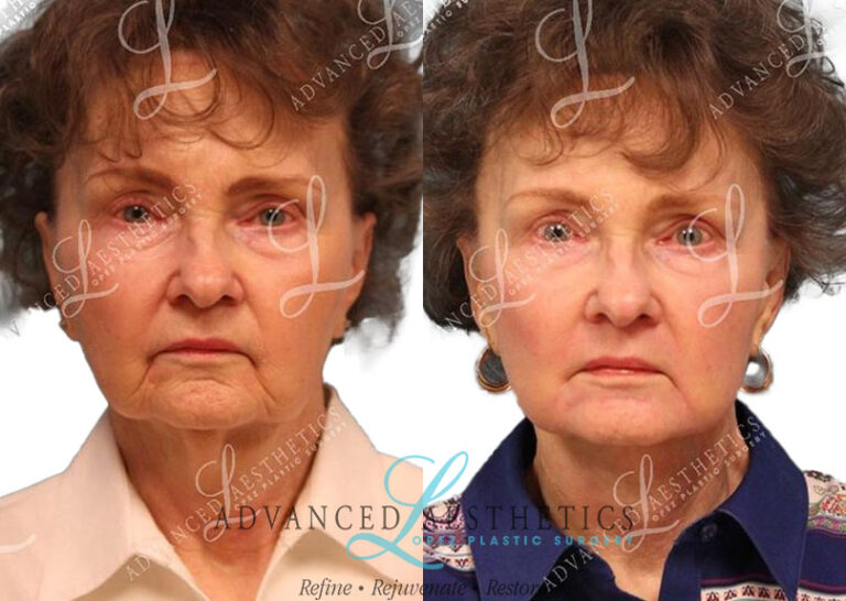 Facelift 38 - Advanced Aesthetics Lopez Plastic Surgery