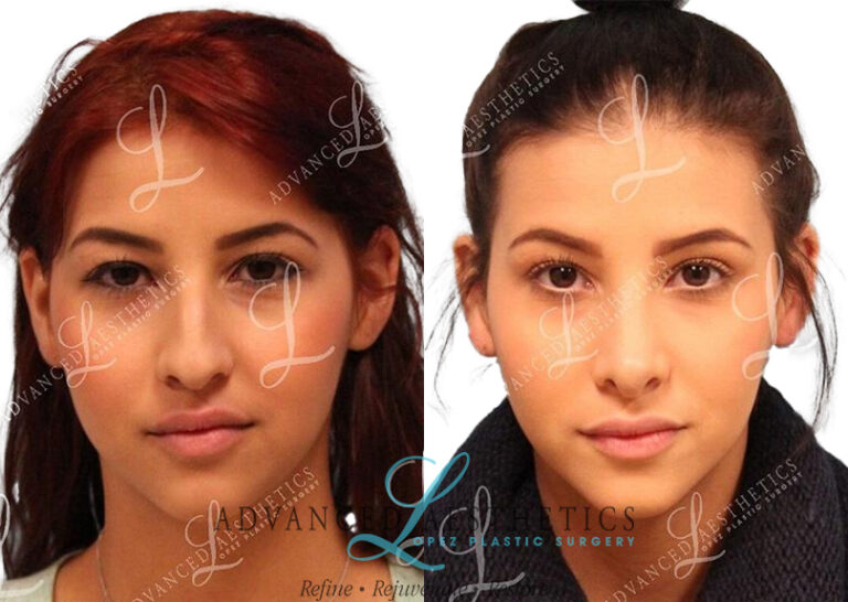 Rhinoplasty 18 - Advanced Aesthetics Lopez Plastic Surgery